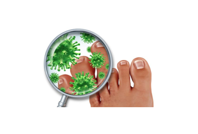 Micoza sau ciuperca piciorului - optiuni de tratament