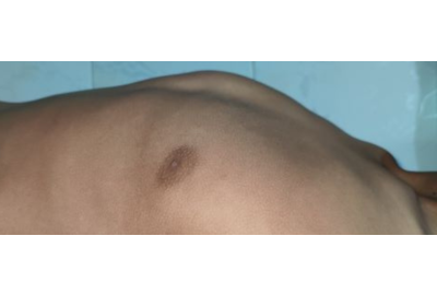 Tot ce trebuie sa stii despre pectus carinatum