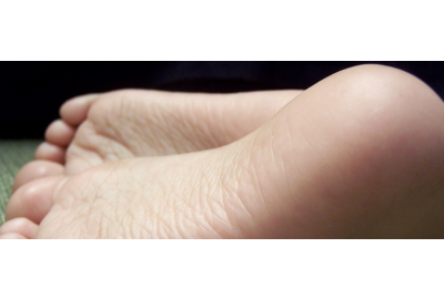 Remedii pentru persoanele care au calcaie crapate